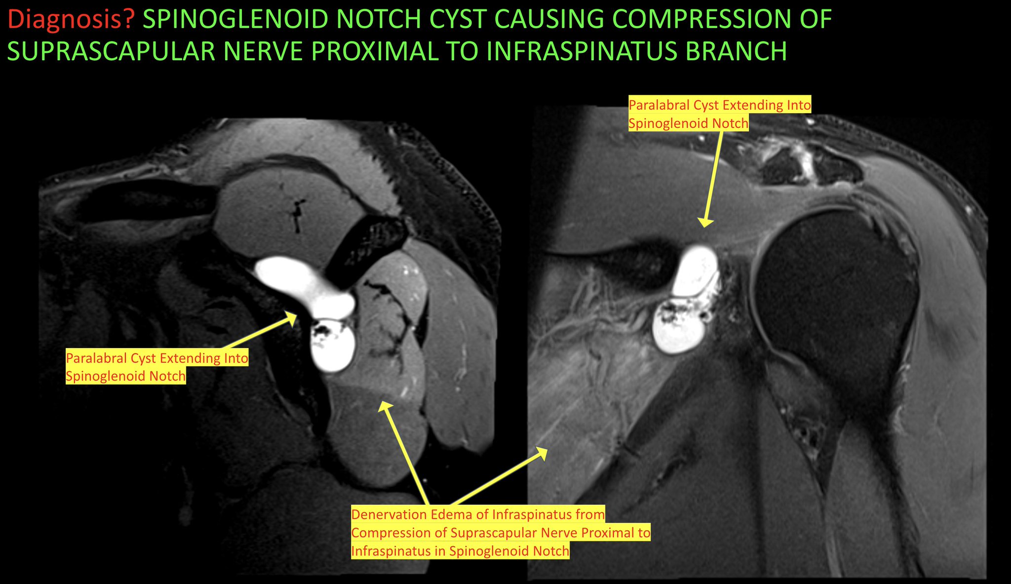 Suprascapular Notch Xray