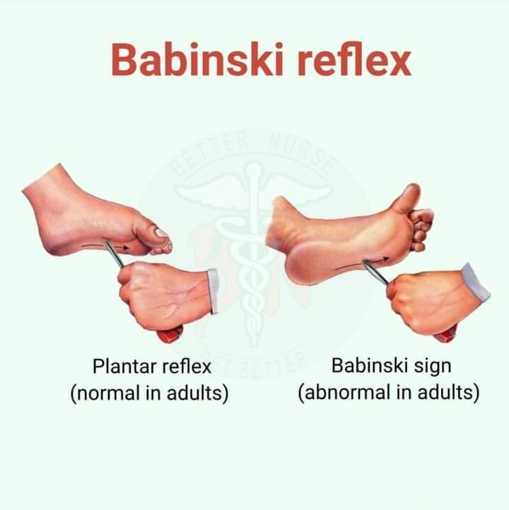 Normal Plantar Reflex