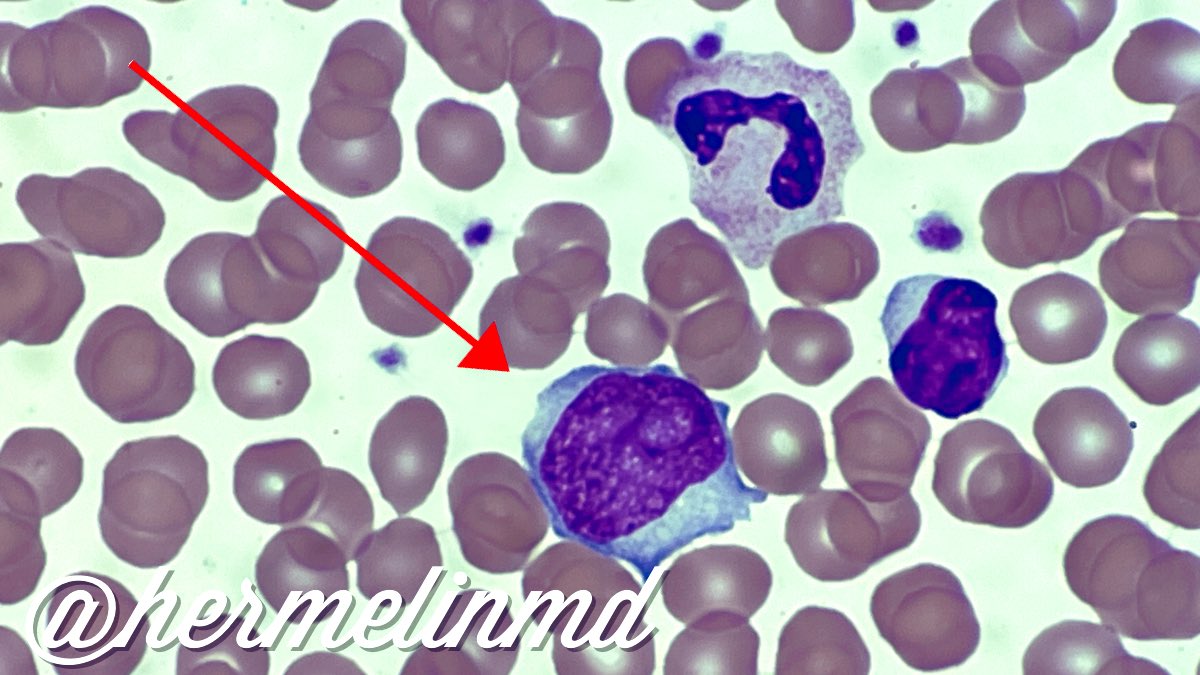 What Are Atypical Lymphocytes