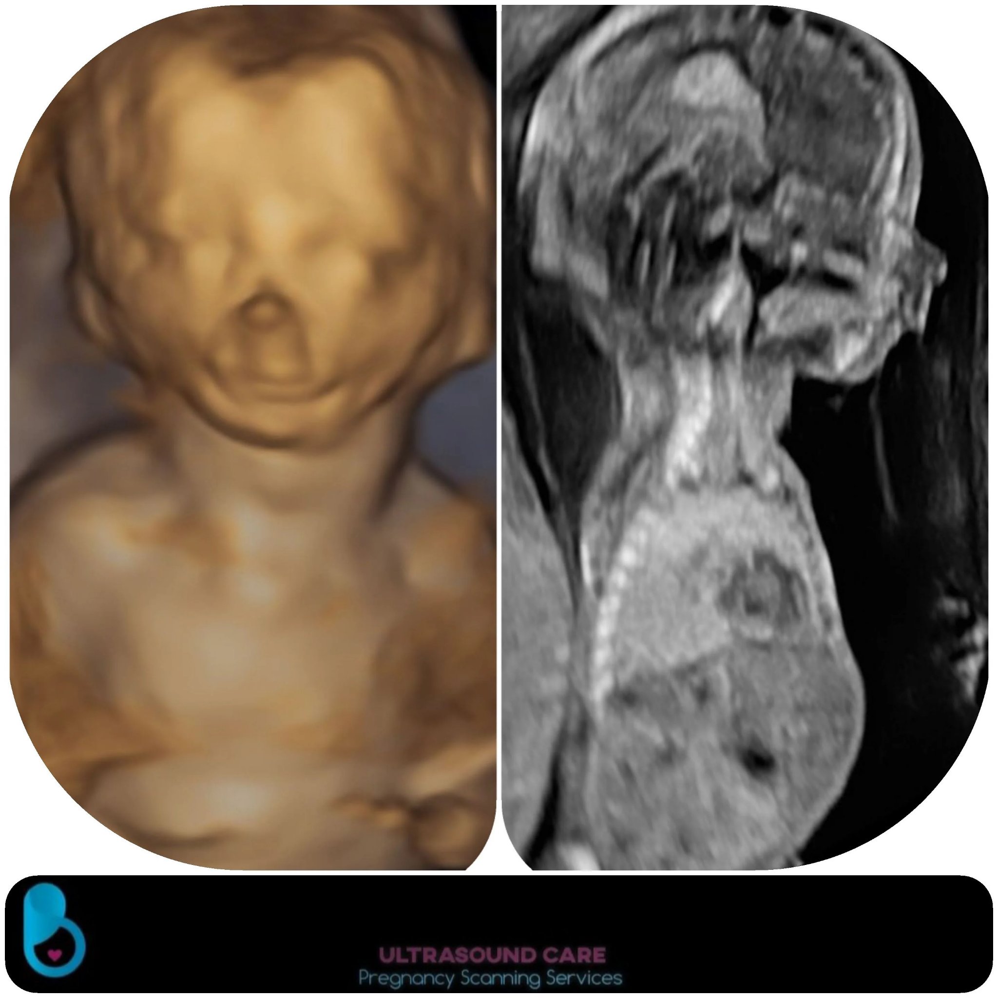 25 Weeks Ultrasound 2d