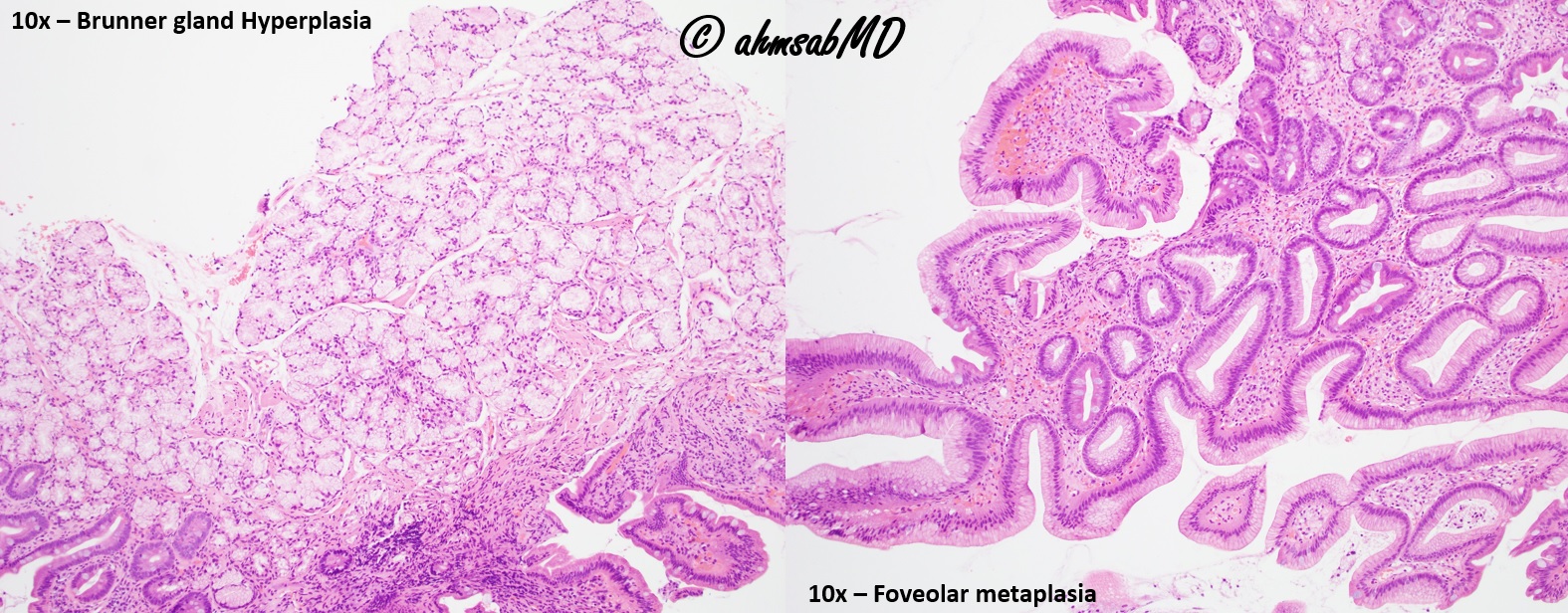 Peptic Duodenitis Educational Case: Immune Related Disorders Of The