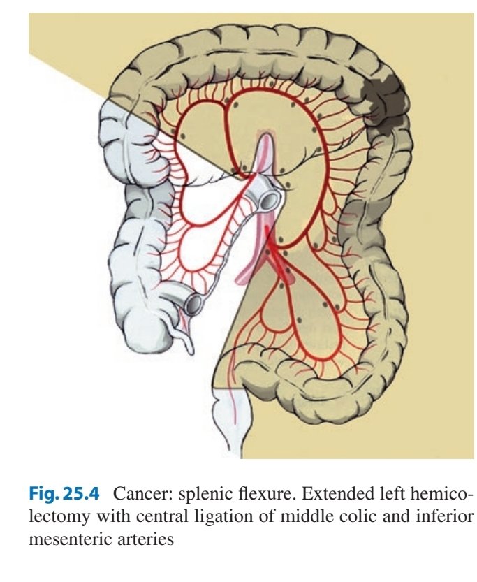 Splenic Flexure Watershed