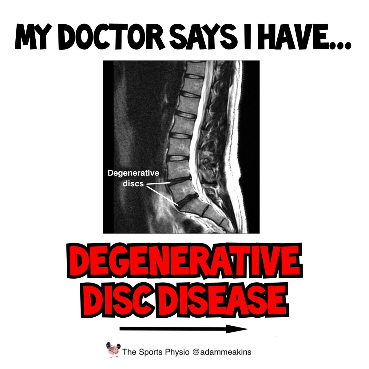 Degenerative Disc Disease Memes Artificial Disc Replacement As An