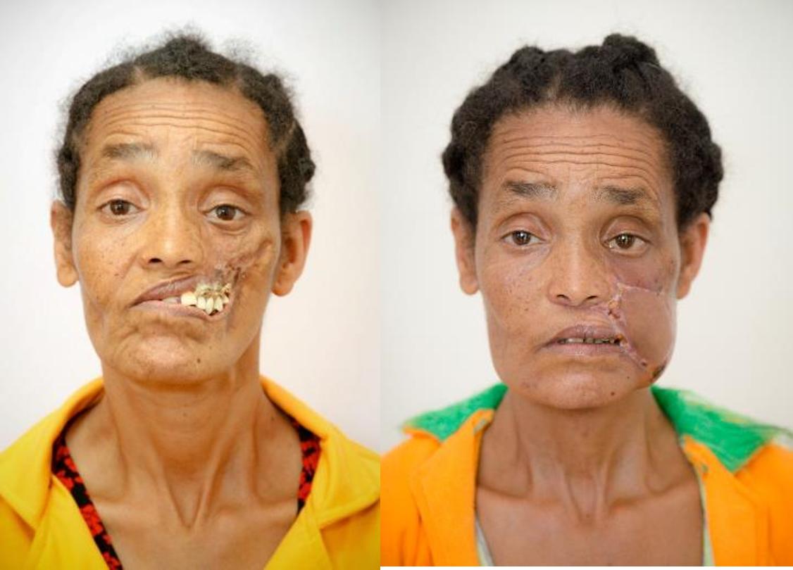 Noma Before And After