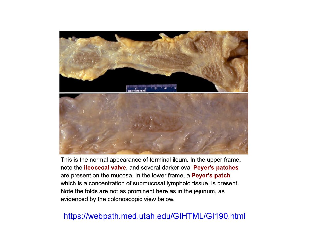 Peyers Patches Gross