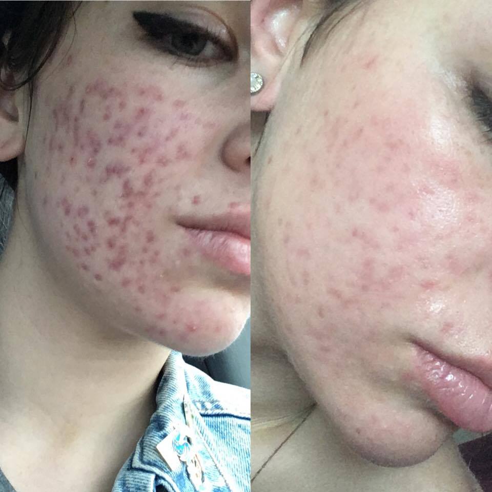 Thread by @cuuracity: "[ACNE SCAR: WHAT YOU NEED TO KNOW] So malam ni ...