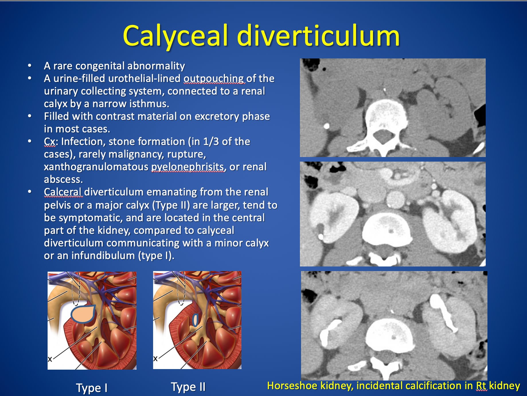 Infundibular In Kidney