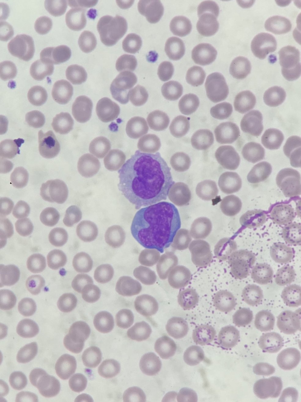 Atypical Lymphocytes Ebv