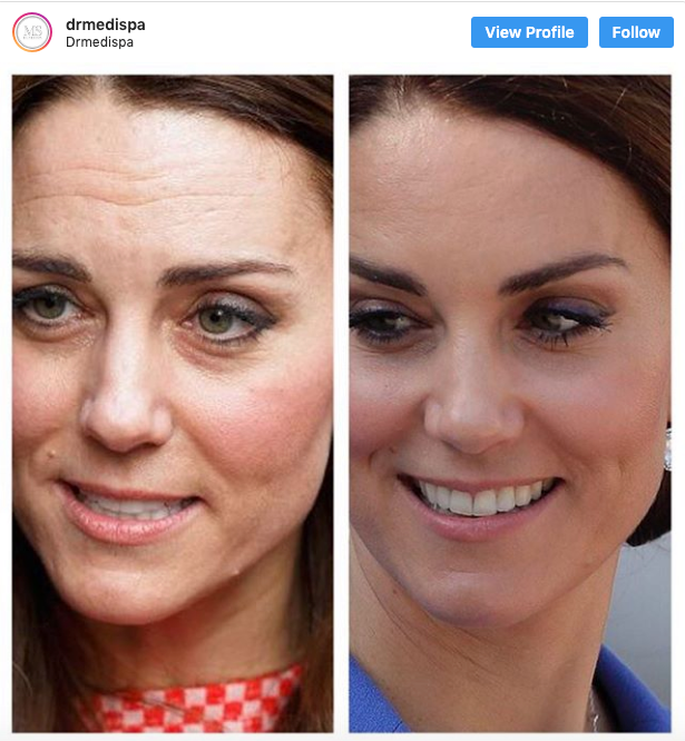 Kate Middleton Nose Job Before And After