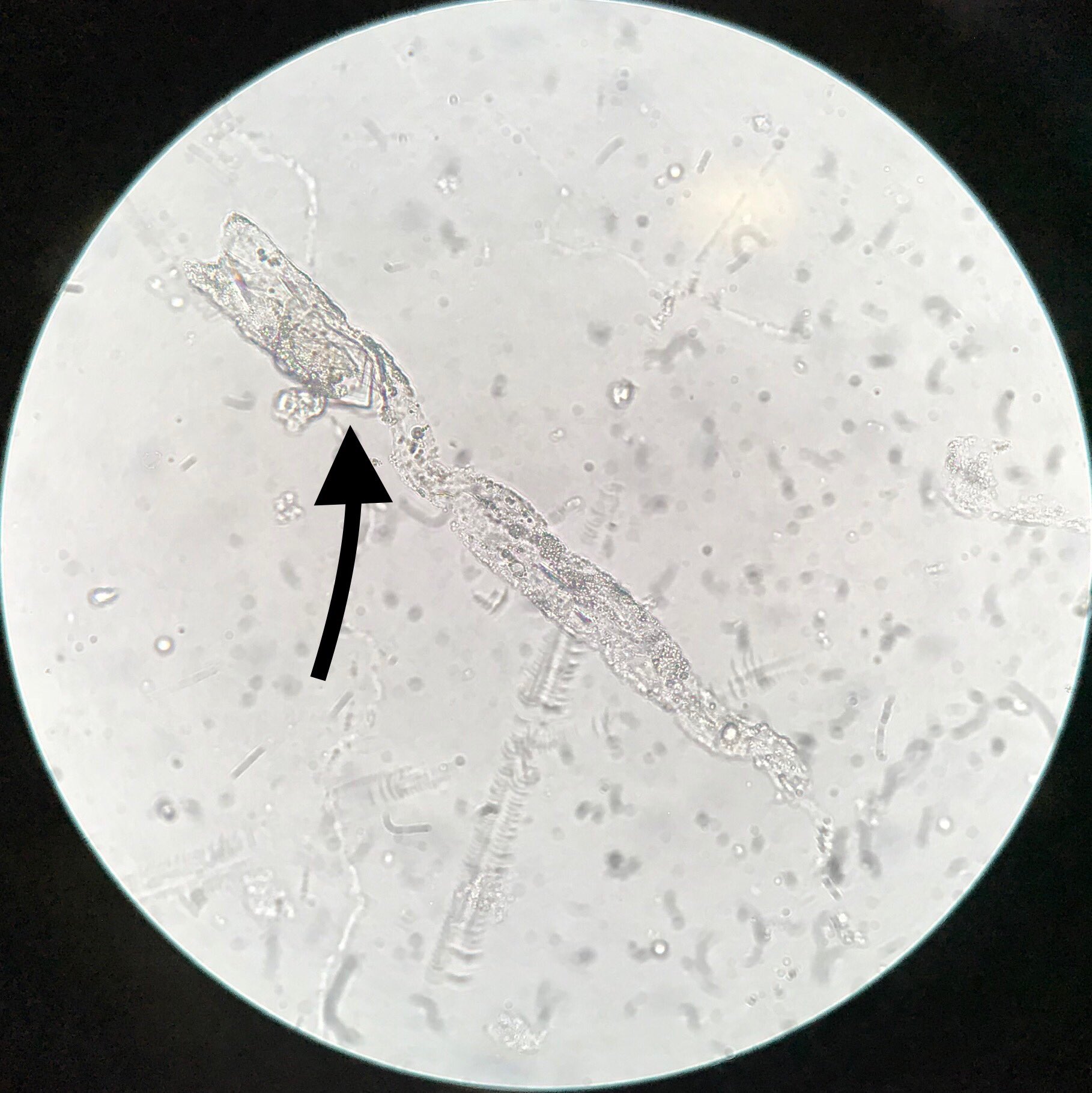 Cholesterol Crystals In Urine Sediment