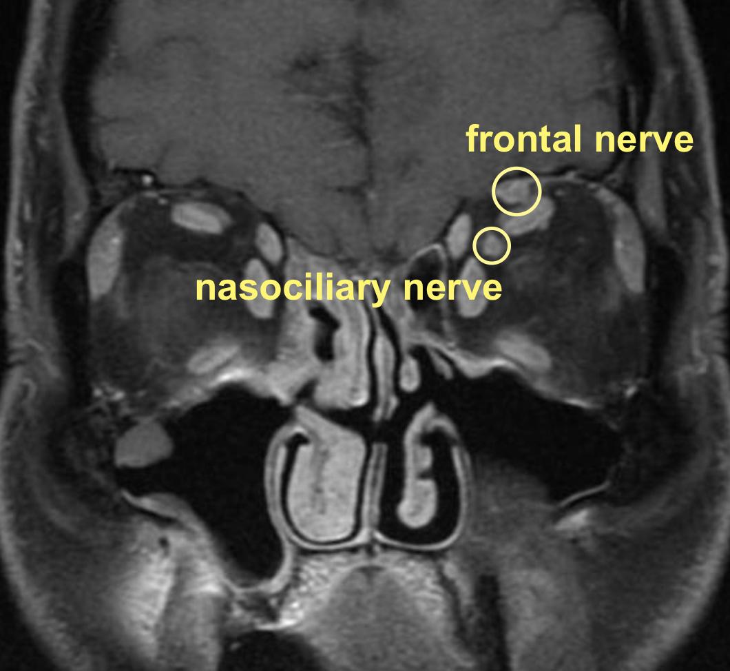 Nasociliary Nerve