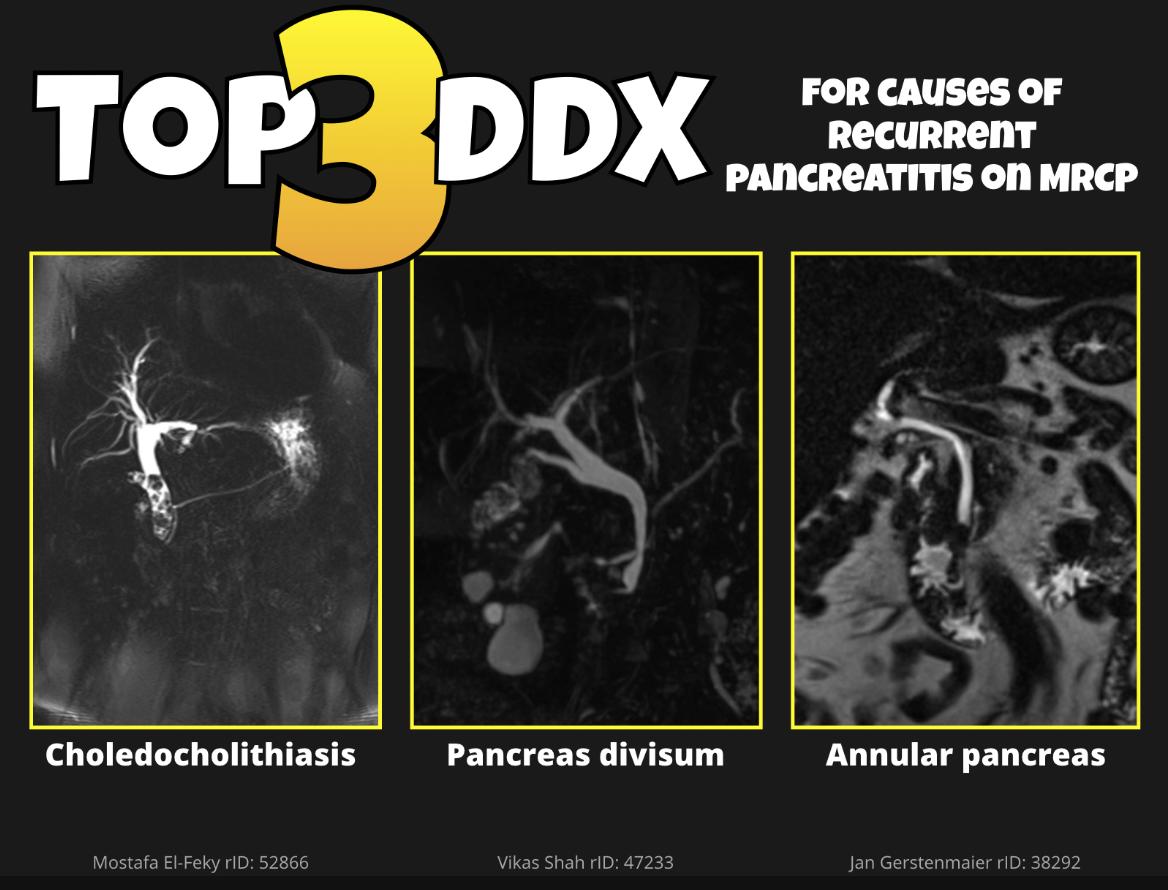 Annular Pancreas Radiopaedia