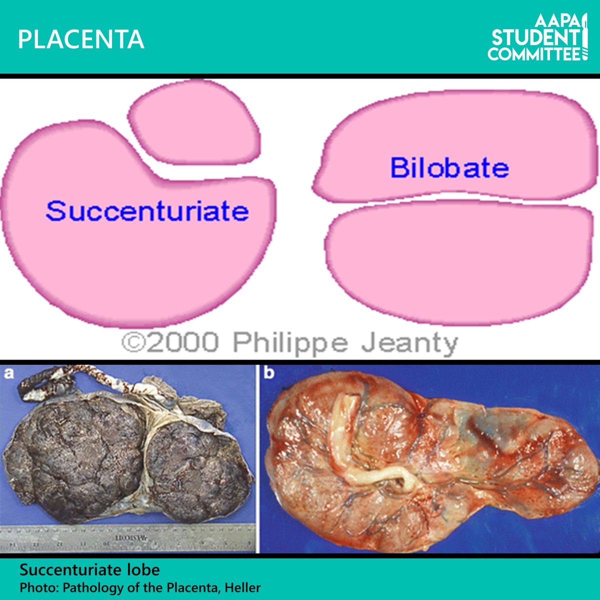 Succenturiate Placenta