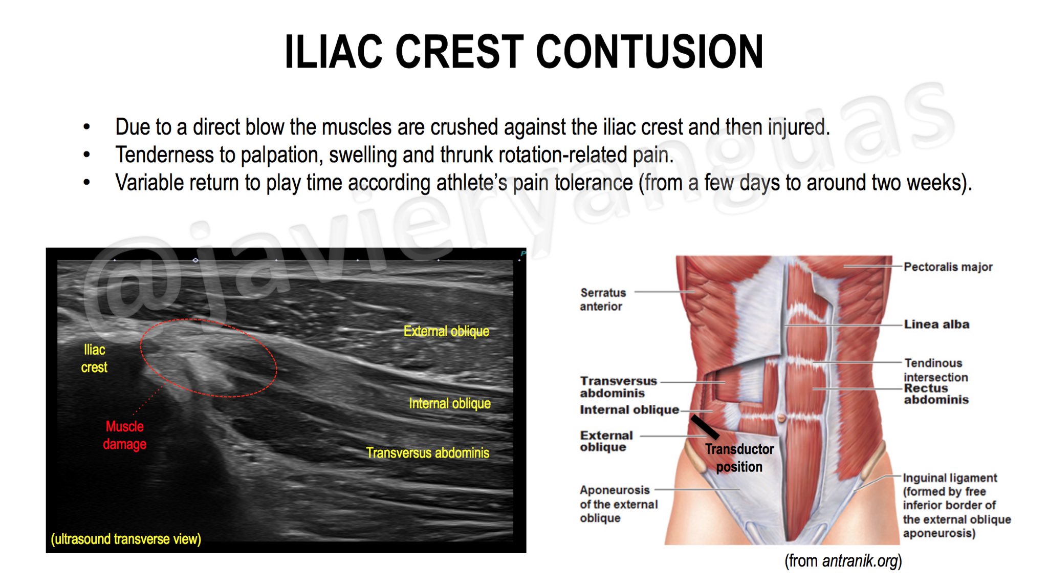 Iliac Crest Muscle Pain