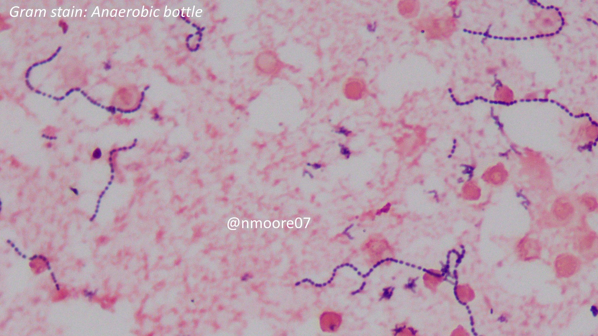 Peptostreptococcus Gram Stain