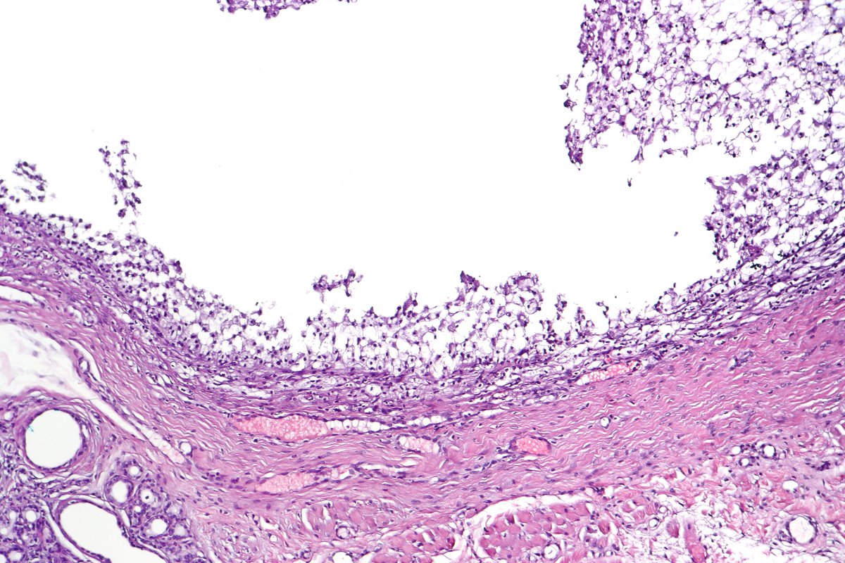 Ranula Histology