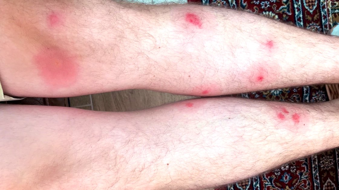 Tracker Jacker Sting