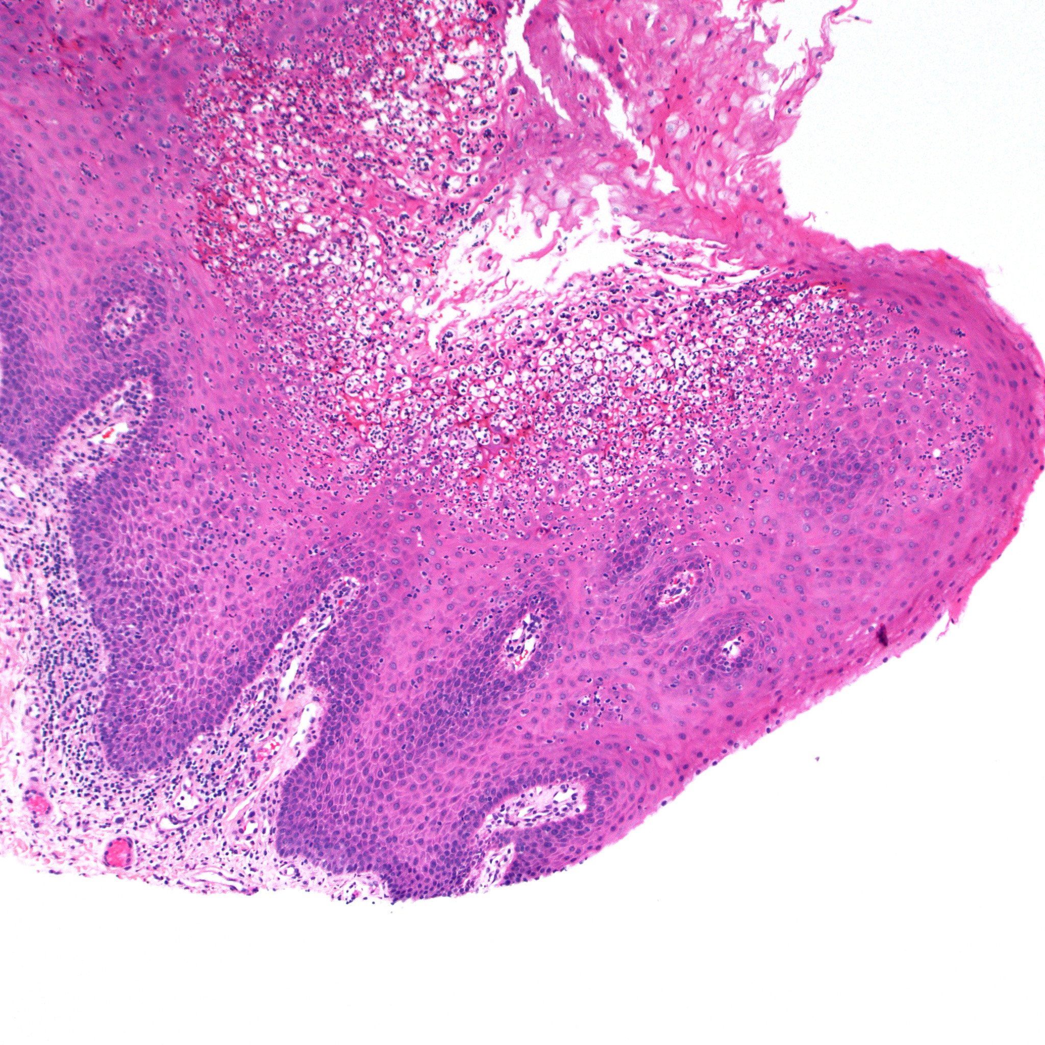 Geographic Tongue Histopathology Tongue An Overview | ScienceDirect