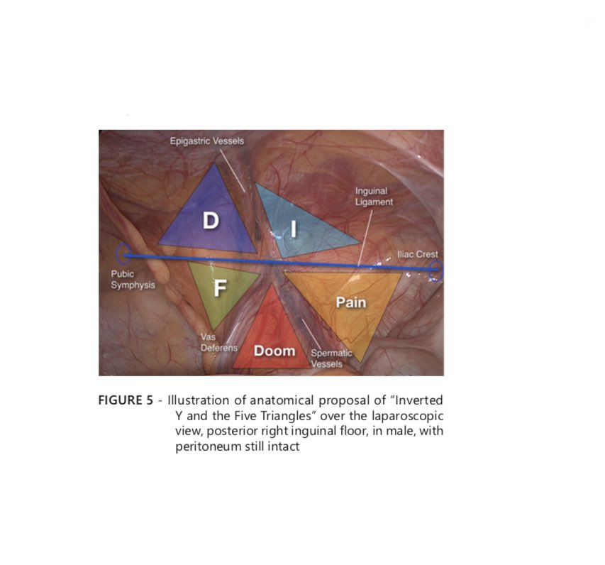 Laparoscopic Inguinal Hernia Repair Triangle Of Doom
