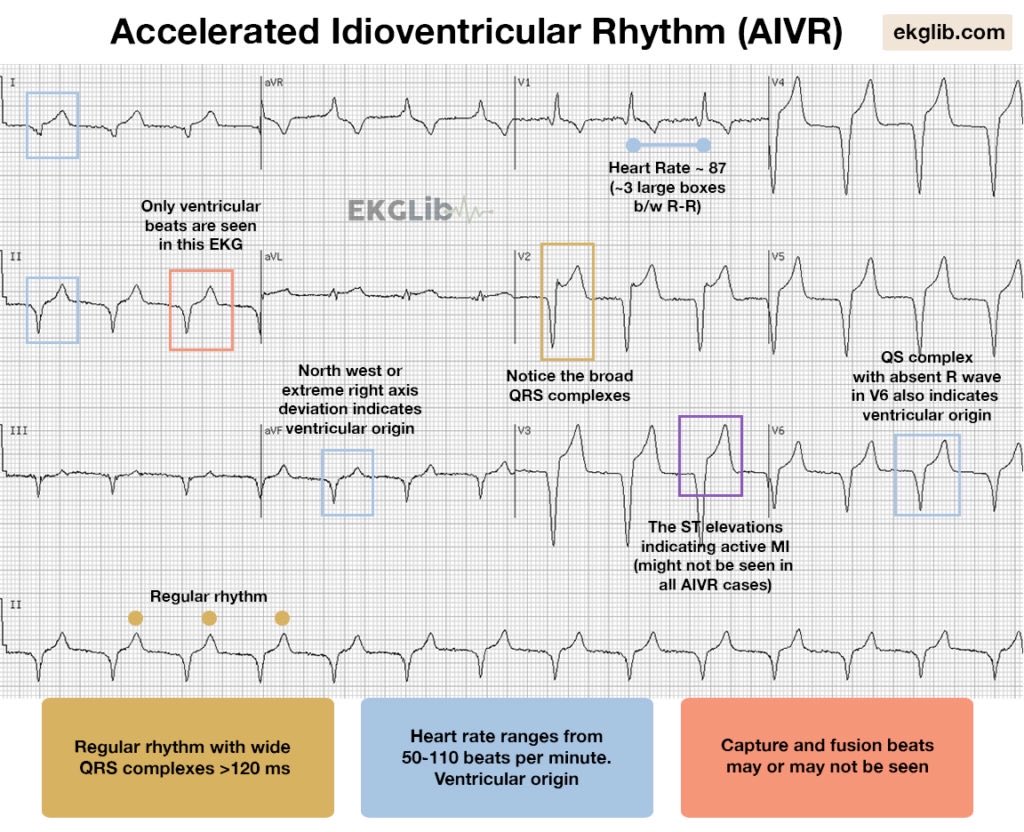 Ventricular Rhythm