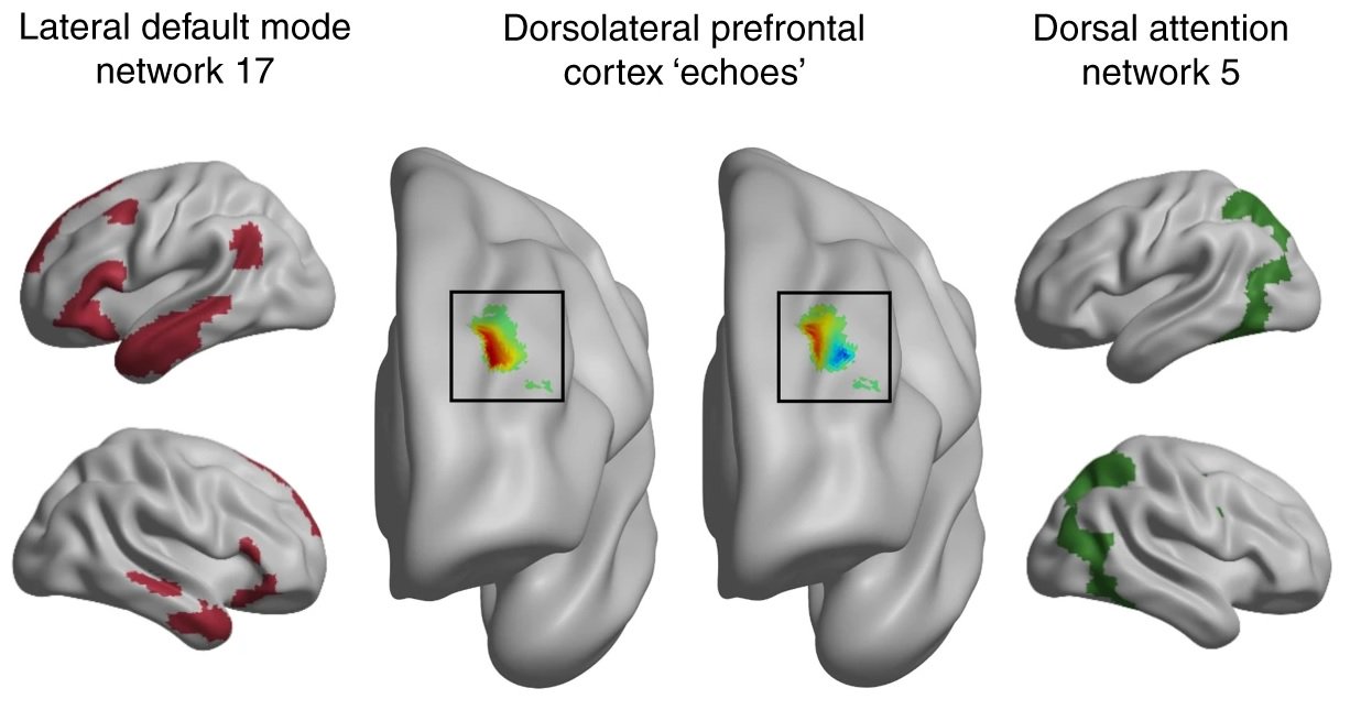 Dorsolateral Prefrontal Cortex