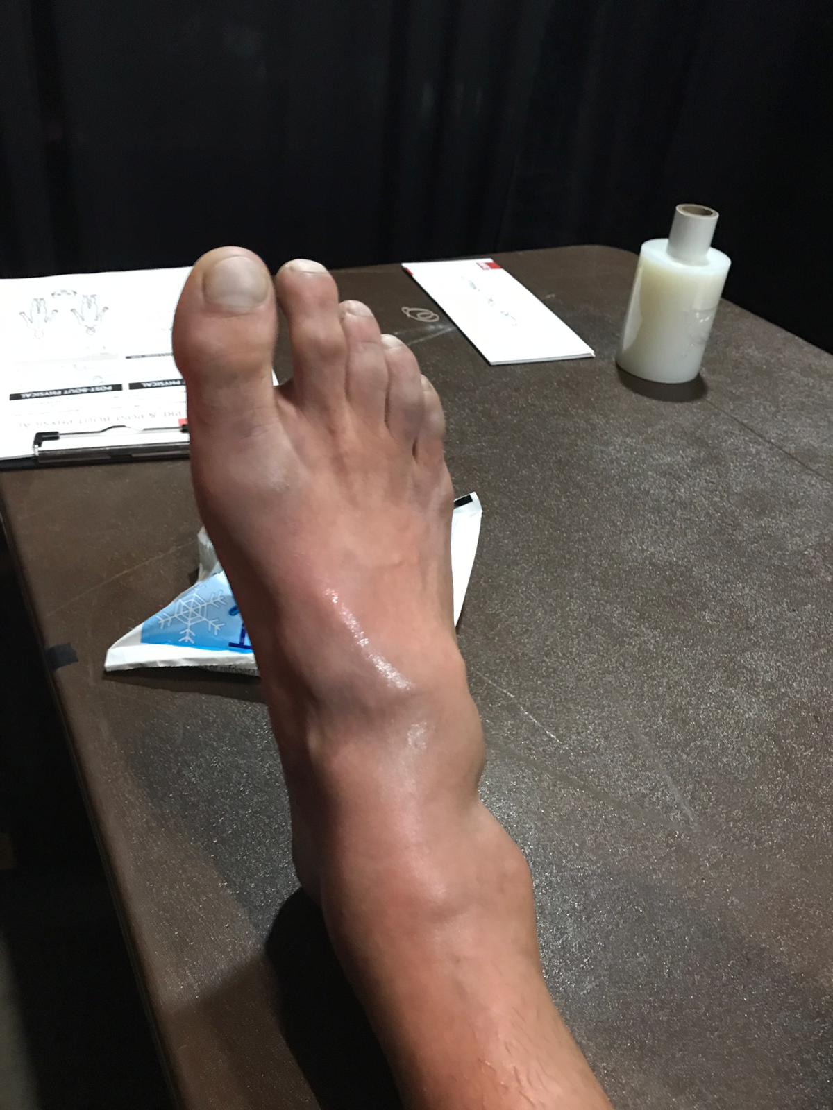 Ufc Broken Toe