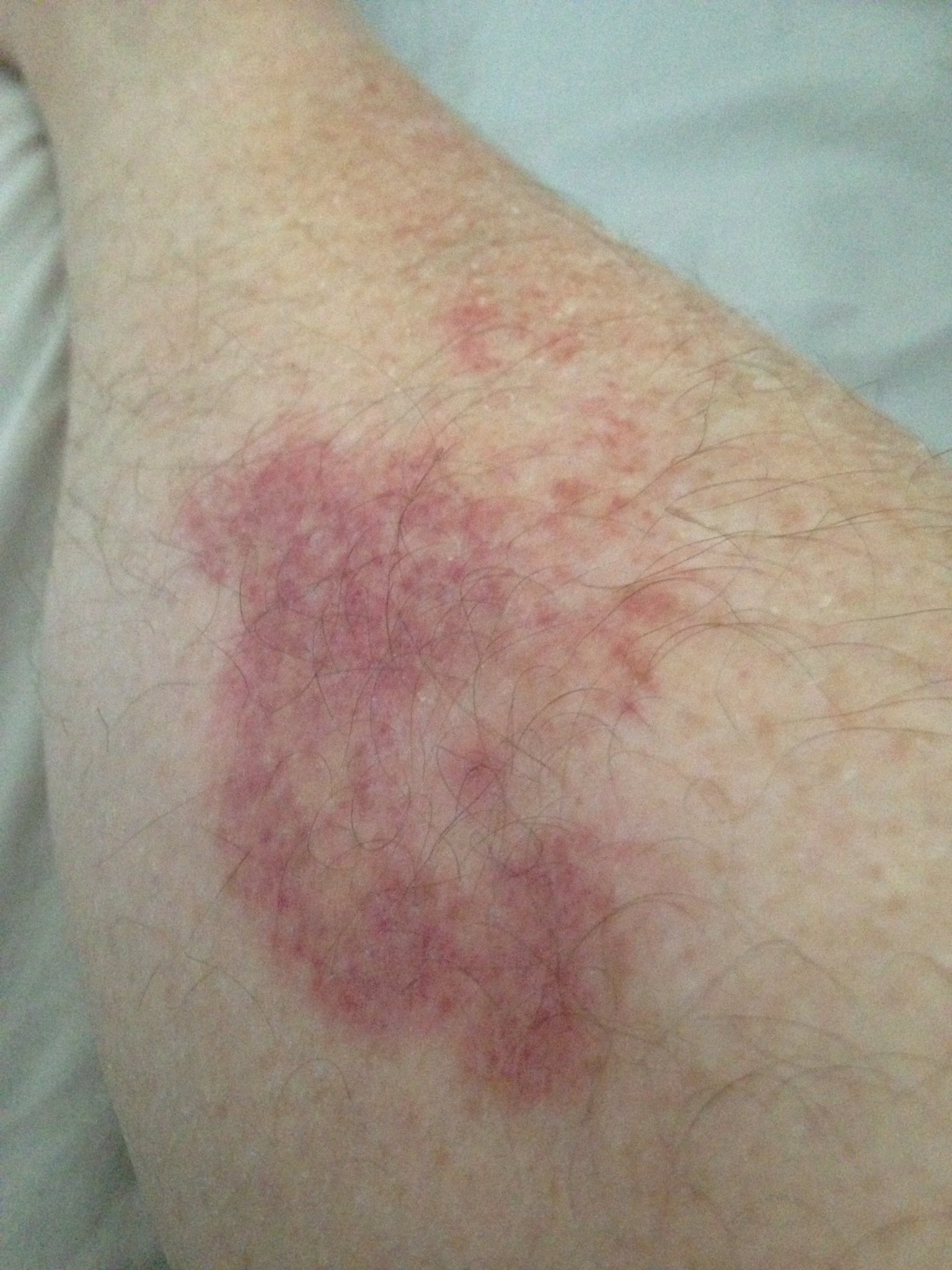 Horse Bite Bruise We Love Getting Abused By The