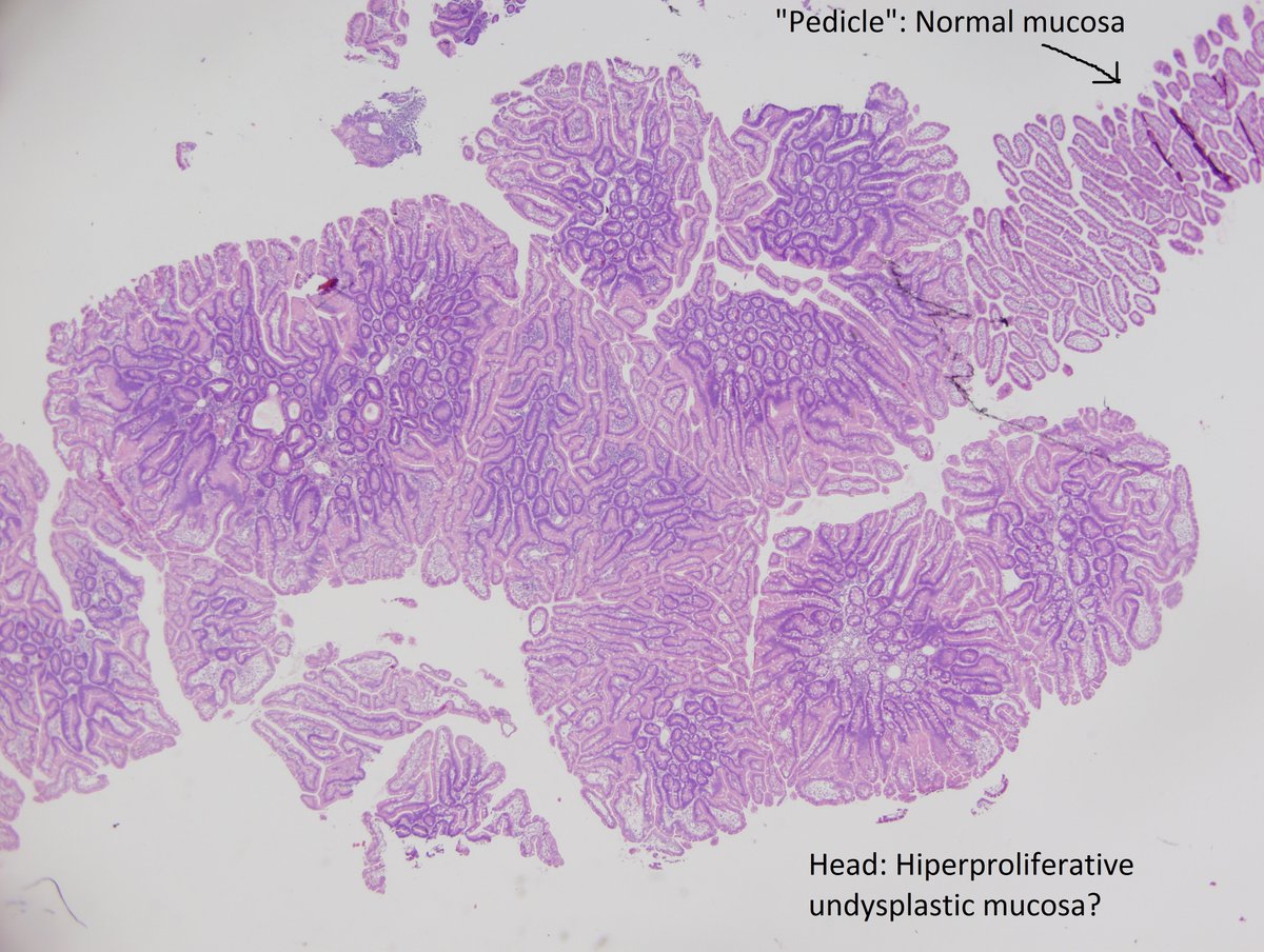 A Thread from @DraEosina: "Mysterious distal duodenal pediculated polyp ...