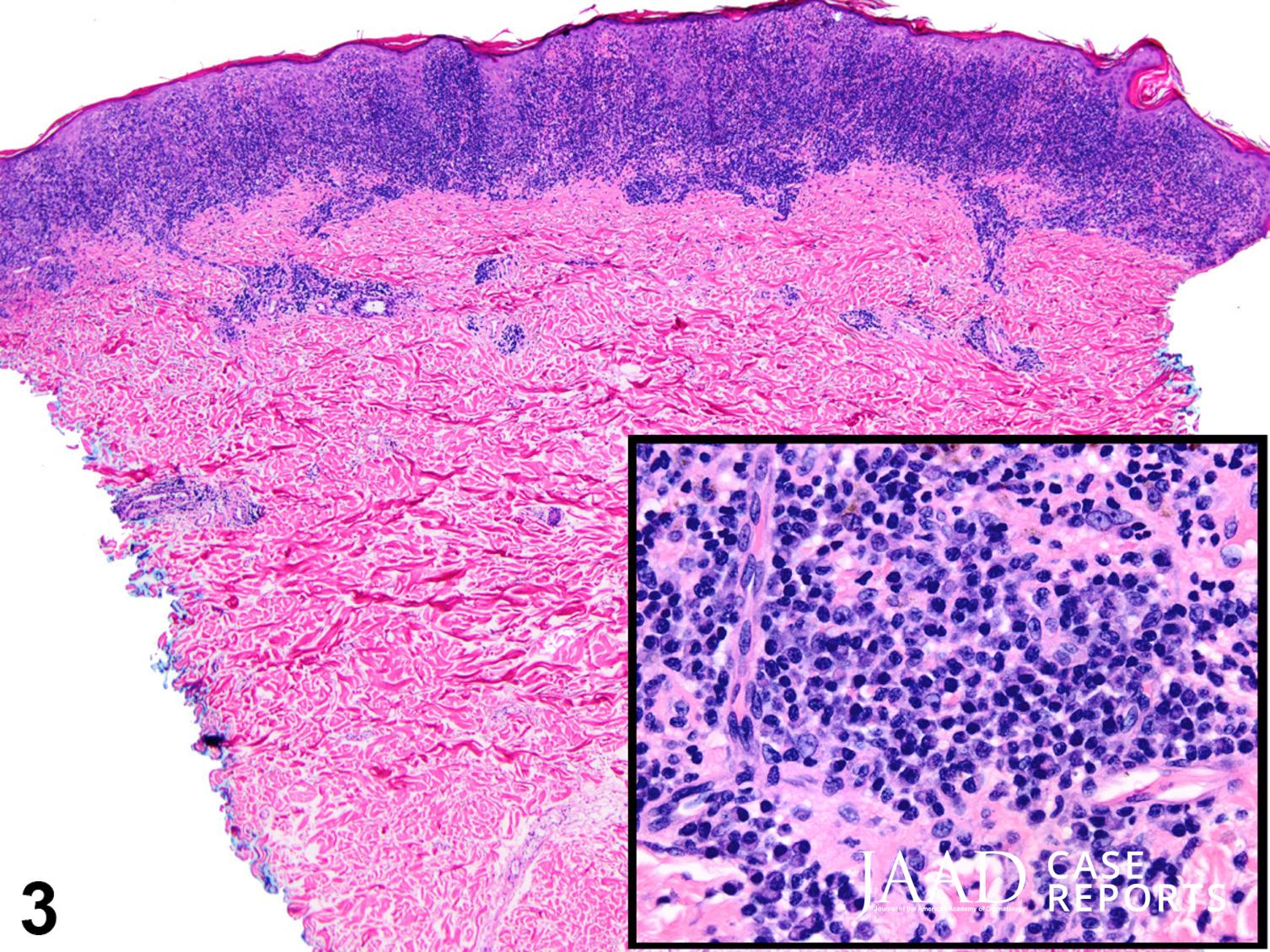 Erythema Toxicum Neonatorum Histology
