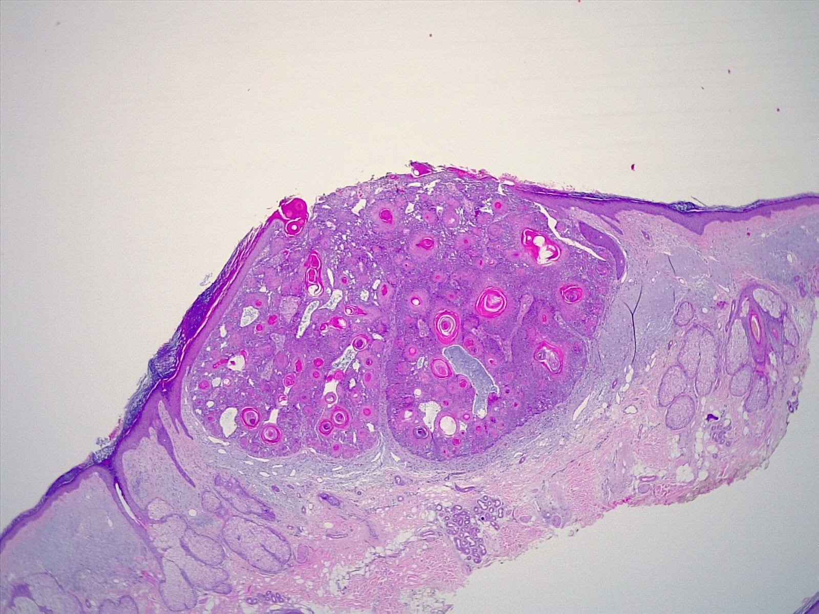 Tumor Of The Follicular Infundibulum