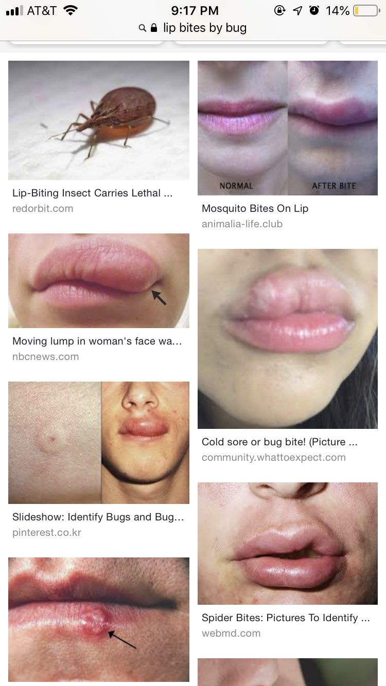 Mosquito Bites On Lip