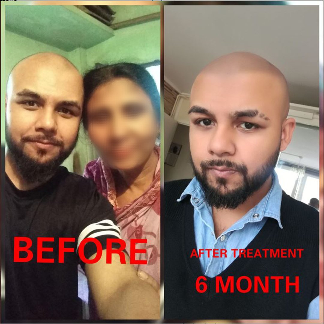 Minoxidil Before And After Beard