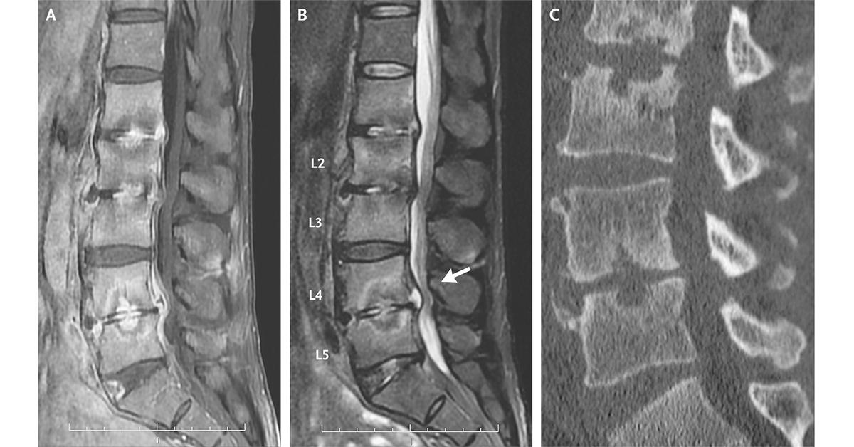 Axial Spondyloarthritis