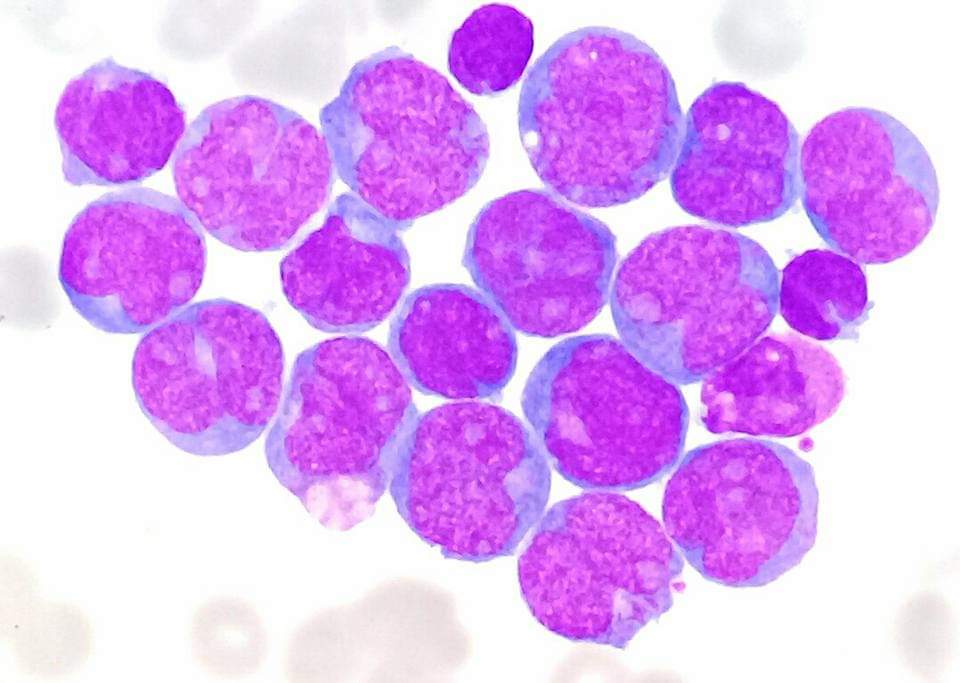 Acute Promyelocytic Leukemia Microgranular Variant