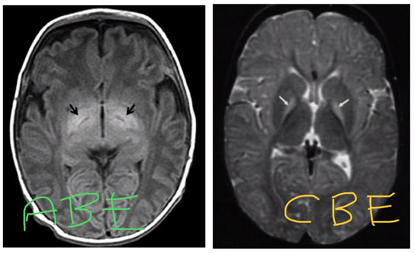 Subthalamic Nucleus Mri