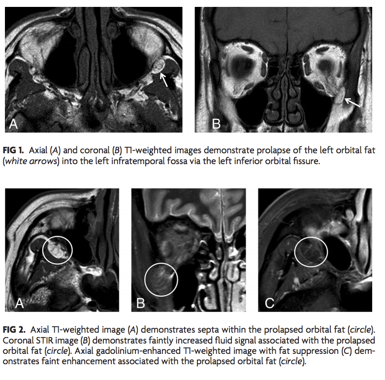 Inferior Orbital Fissure Radiology CT Of The Orbit: Anatomy