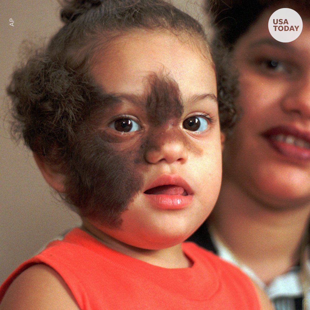 Wolfman Syndrome Hypertrichosis – FNXCML