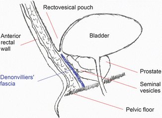 Puboprostatic Ligament