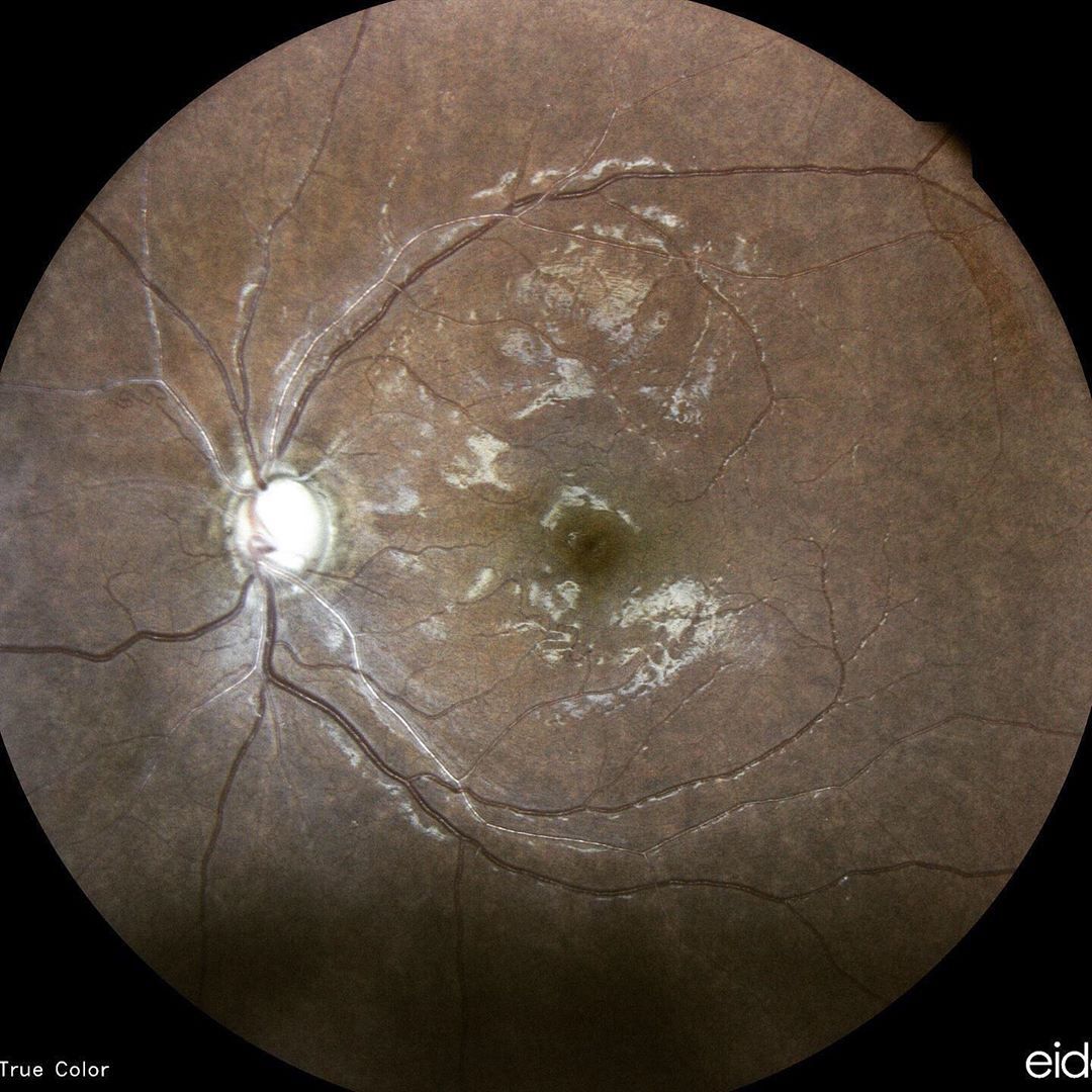 Hypertensive Retinopathy Silver Wiring
