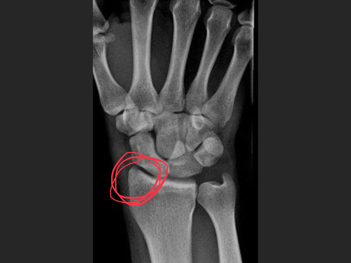 Styloid Process Of Radius Pain