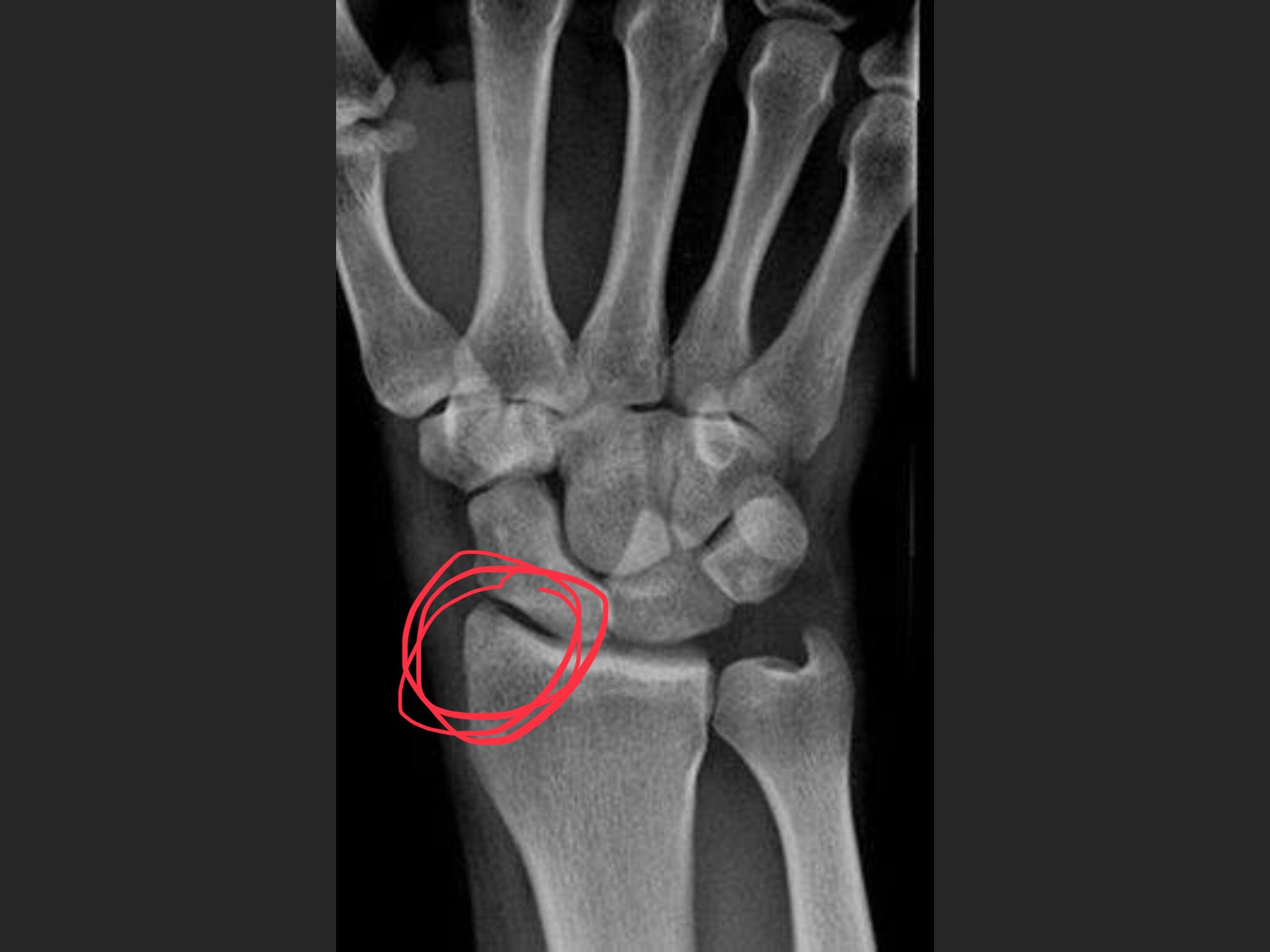 Styloid Process X Ray