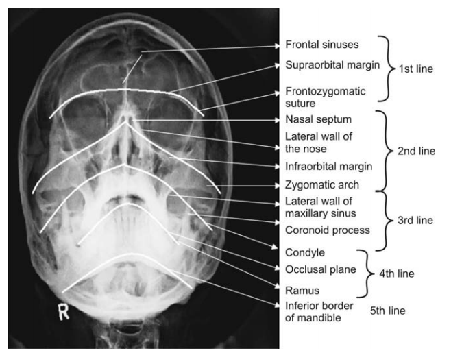 Infraorbital Margin