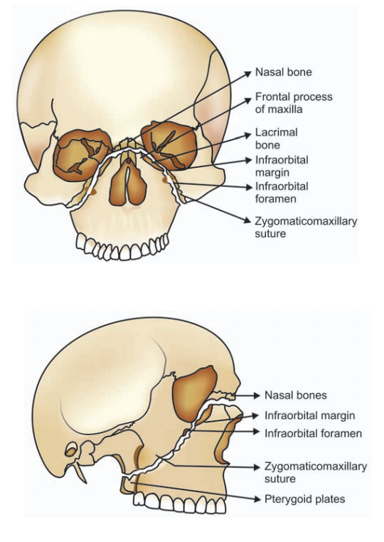 Frontal Process Of Maxilla Fracture