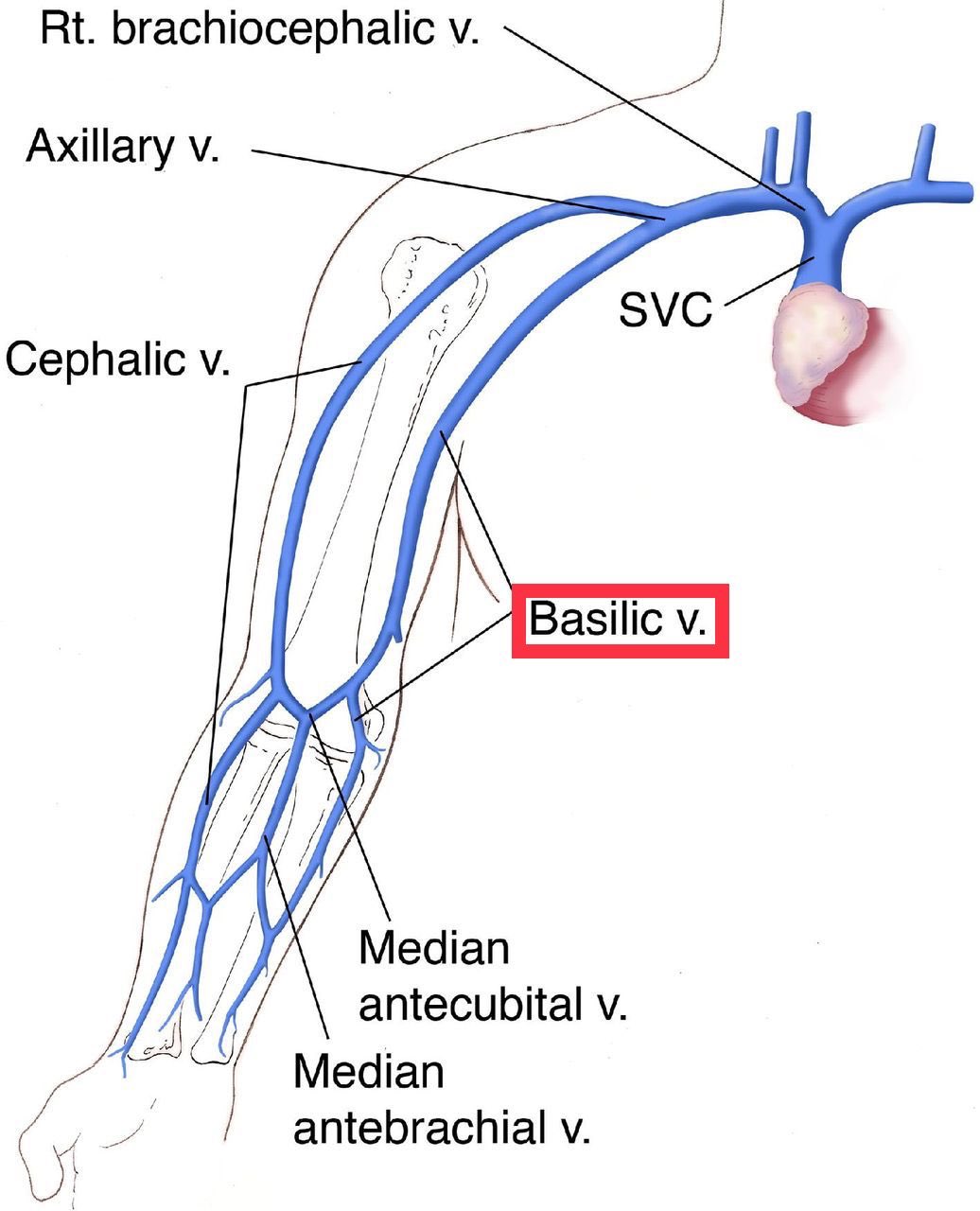 Picc In Innominate Vein
