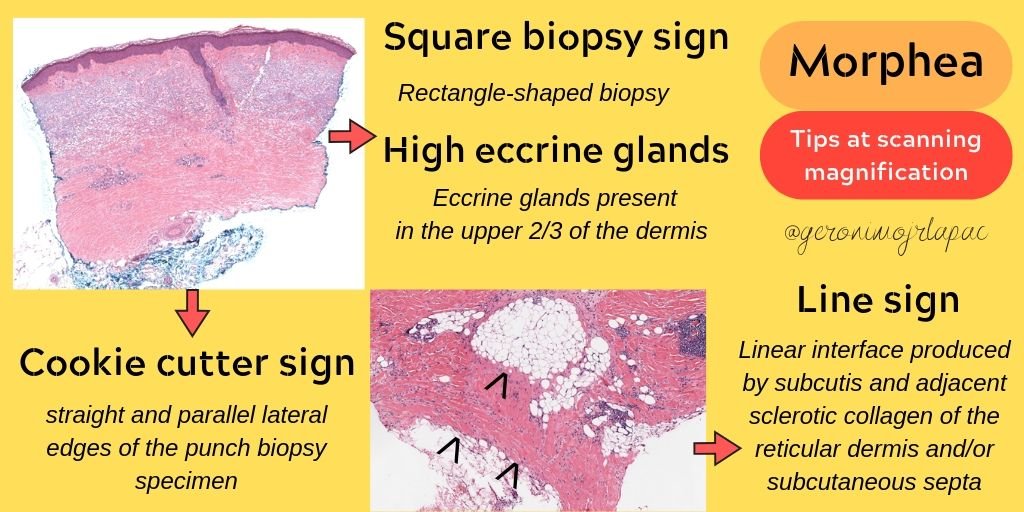 Morphea Histopathology
