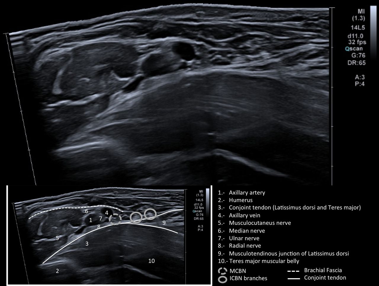 Axillary Block Ultrasound