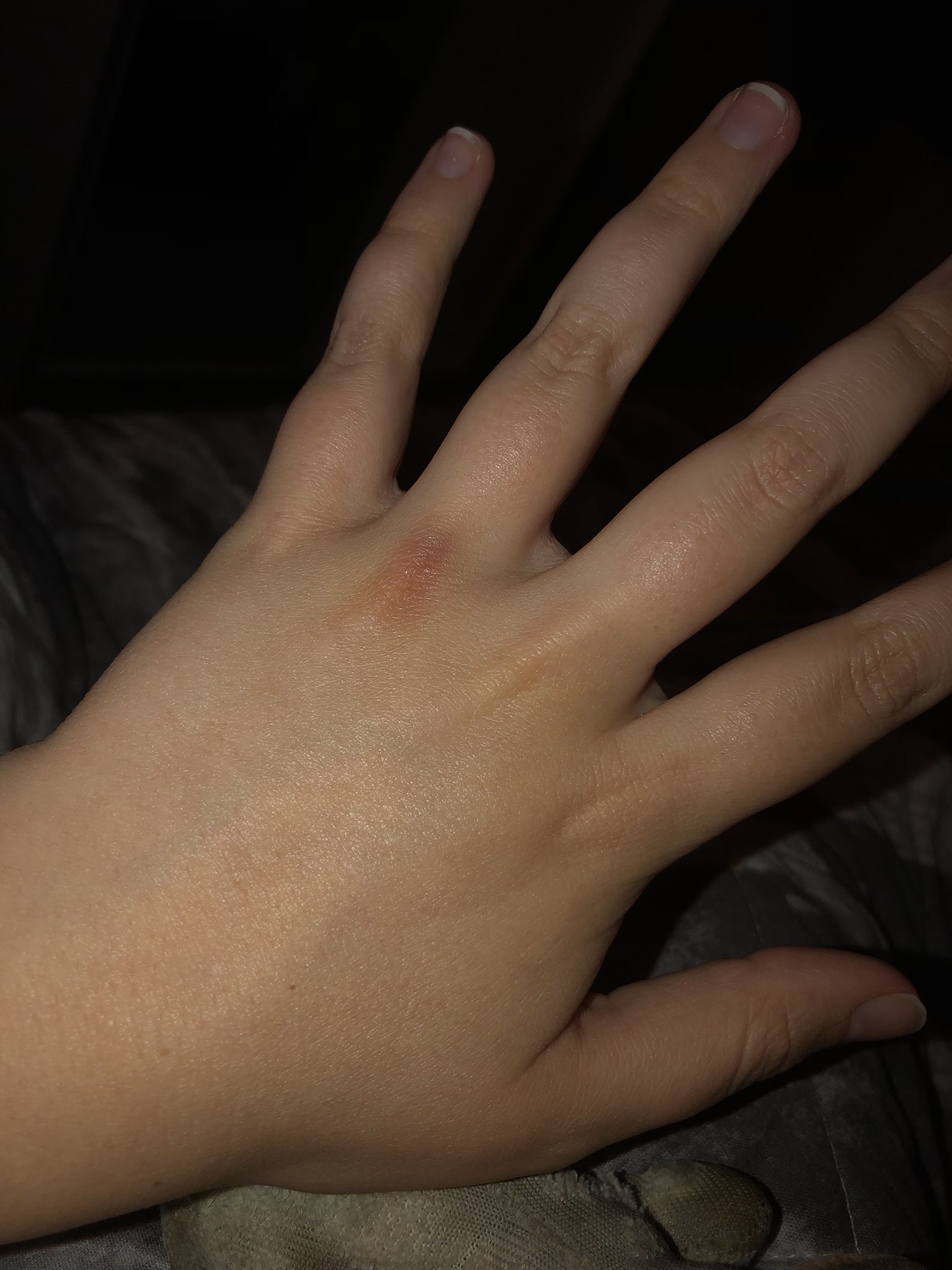 Bruised Black Knuckles Give Me Dreams Like Bruised Knuckles That