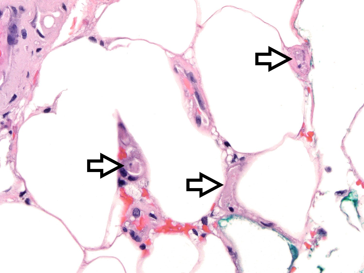 Calciphylaxis Histology Calcinosis Cutis And Calciphylaxis | Actas