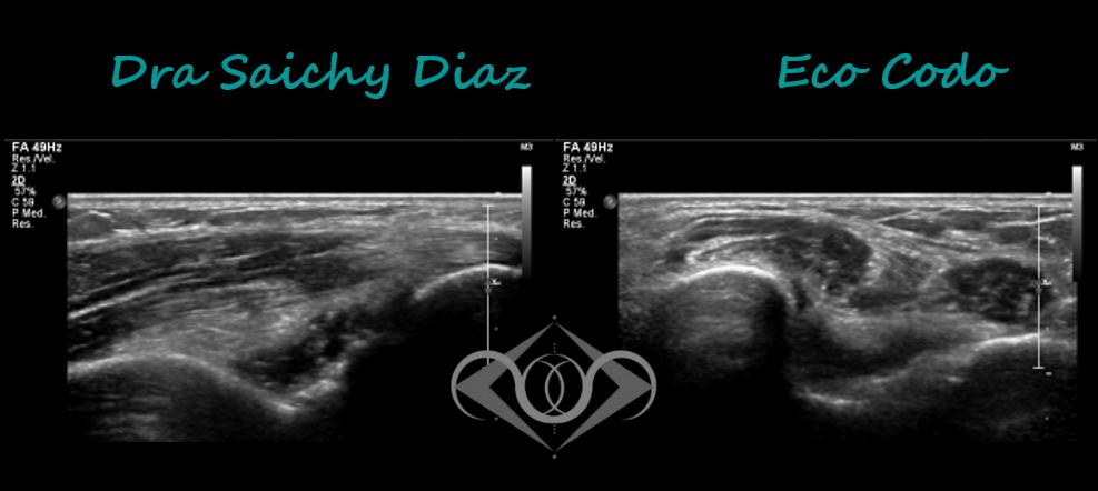 Guau comerciante práctica bursitis olecraniana codo Inminente ...