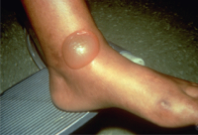 Cellulitis Foot Blister